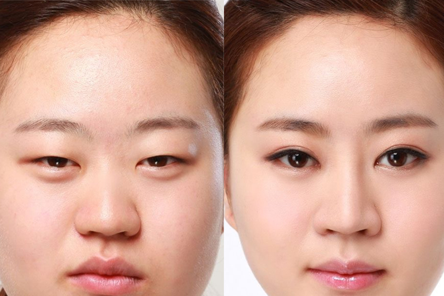 Sụp mí mắt: Phân loại bệnh và cách điều trị hiệu quả